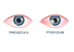 What You Should Know About a Pinguecula and a Pterygium