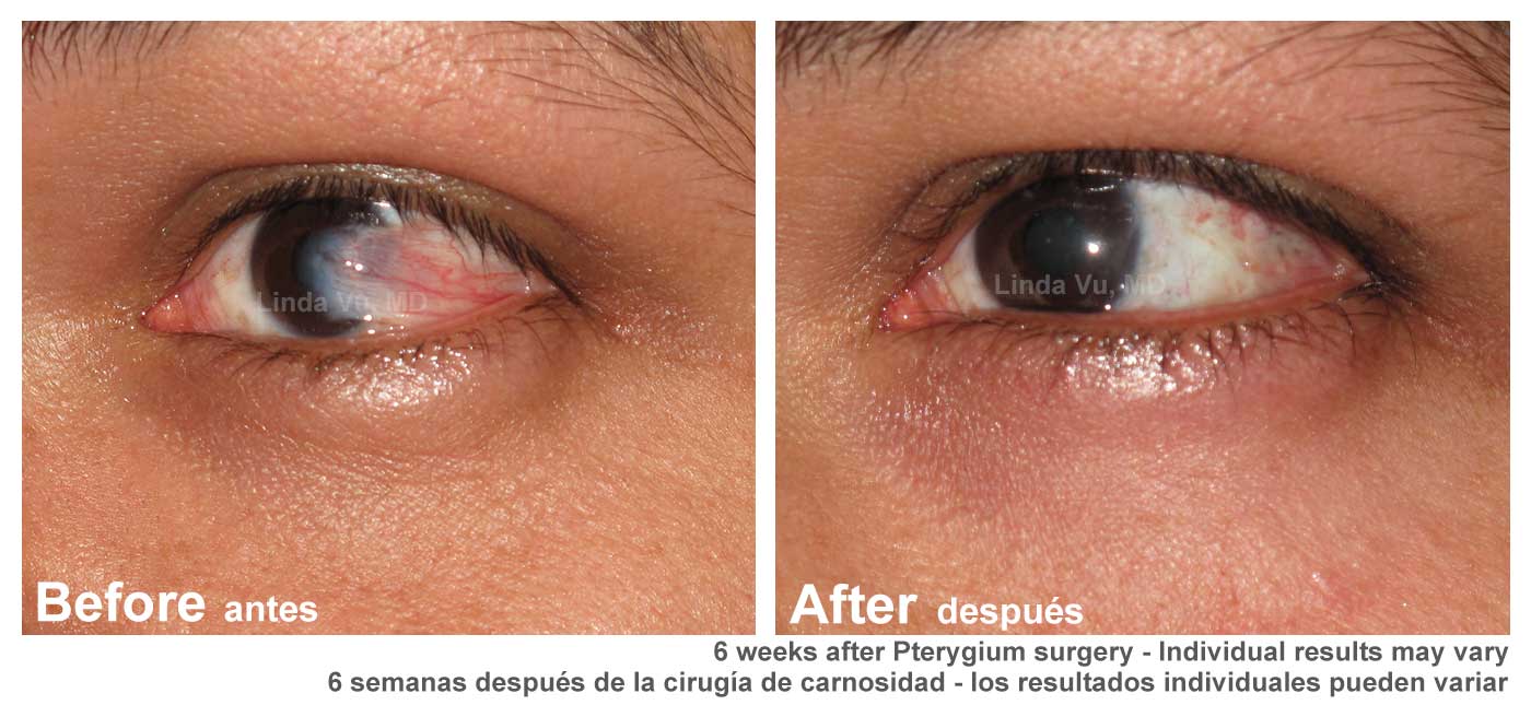 Pterygium Surgery Before & After Photos Monterey Park